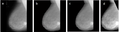 Mammogram Preprocessing A Original Mammogram B Additional Objects Download Scientific
