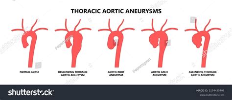 Anévrisme Aortique Thoracique Classification De Lanatomie Image Vectorielle De Stock Libre