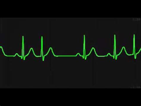 Junctional Trigeminy YouTube