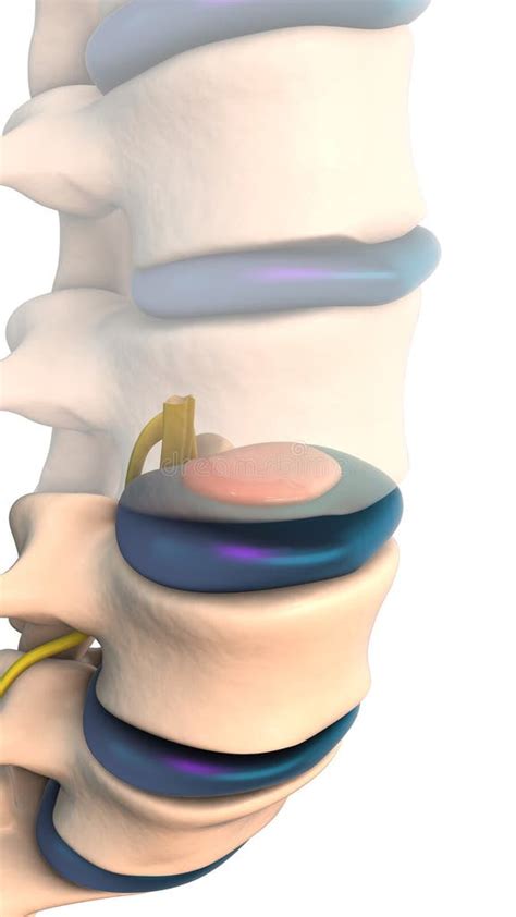 Slipped Disk Or A Ruptured Disk Stock Illustration Illustration Of
