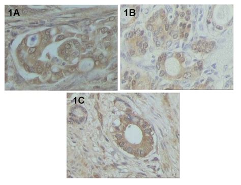 Representative Cases Of Hsps Protein Expression In Tumor Cells Of