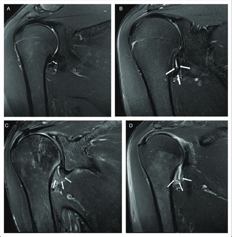 Measurement Of The Joint Capsule At Axillary Recess Level And Its