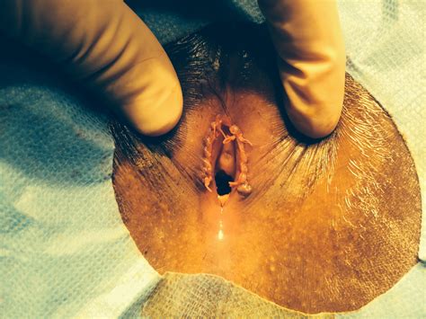 Excision Docteur Benchimol Gynécologue Obstétricien à Paris France