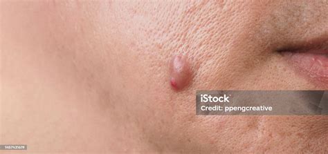 Bacterial Skin Infection Big Acne Cyst Abscess Or Ulcer Swollen Area