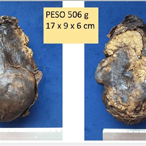 Macroscopic Illustration Of The Nephrectomy Specimen A Anterior And