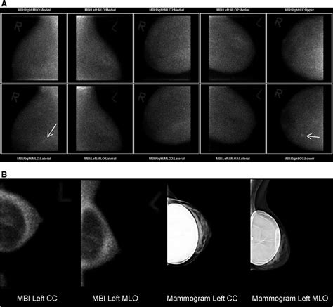 Best Practices In Molecular Breast Imaging A Guide For Technologists