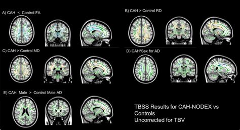 Results From The Tbss Analyses Using Tfce Threshold Corrected For Sex