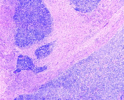 Endometrial Stromal Sarcoma Libre Pathology