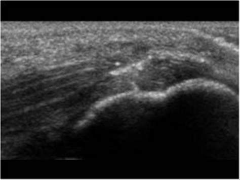 Musculoskeletal Joints And Tendons 62 Elbow Case 625 Olecranon