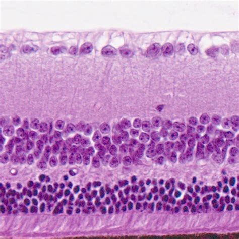 Study Links Female Sex Hormones To Progression Of Eye Disease Newsroom