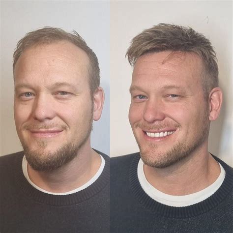Hair Systems Before And After Toupee Hairstyles