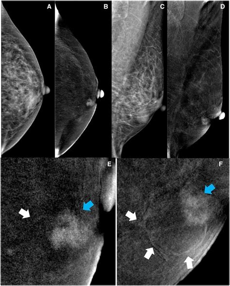 Addition Of Contrast Enhanced Mammography Enhancement Patterns And