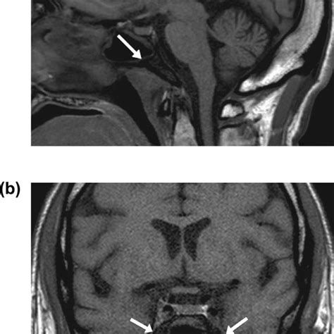 A Mri Of The Skull Base Was Performed On Day 1 Of Admission Sagittal