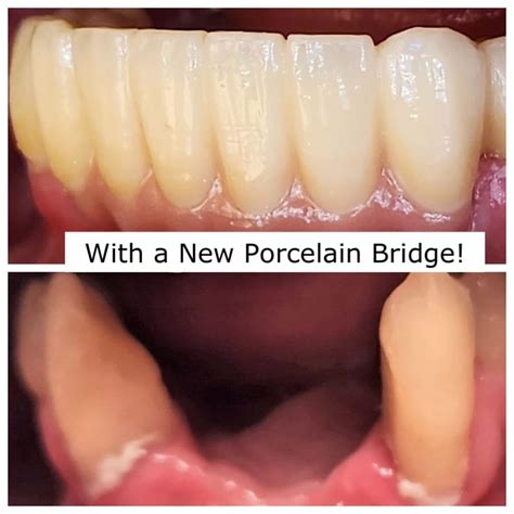 Dental Bridge Front Teeth Before And After