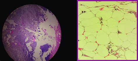 Calciphylaxis Biopsy Download Scientific Diagram