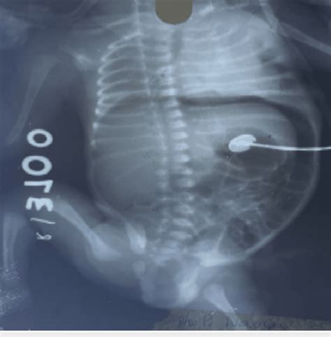 Abdominal Radiograph In Supine View Showing Pneumoperitoneum Download Scientific Diagram