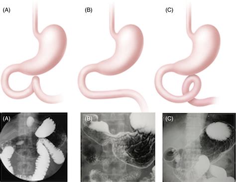 Ligament Of Treitz Diagram