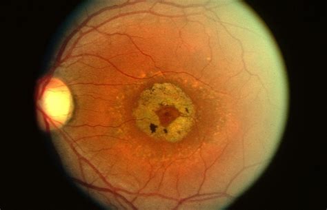 Stargardt Disease Nhs Maladie De Stargardt Diagnostic Gqvul