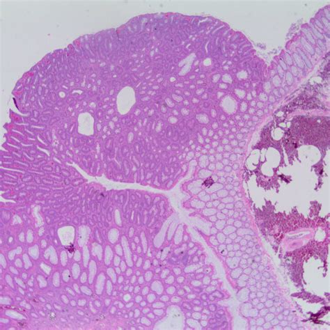 Gross Appearance Of The Large Bowel In Sessile Serrated Lesion Polyp Download Scientific Diagram