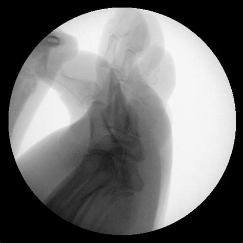 Orthodx Nonreducible Toe Dislocation Clinical Advisor