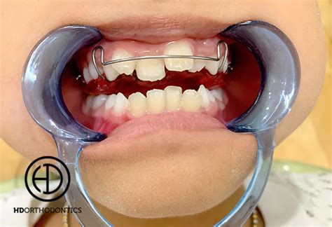 Crossbite Teeth Braces