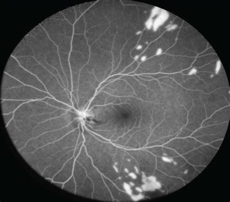 Clinical Presentations Of A Patient With Thyroid Eye Disease Experience