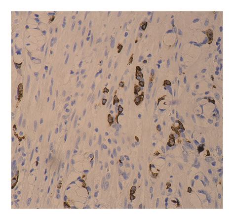 Goblet Cell Carcinoid Of The Appendix Immunohistochemically The Goblet Cell Carcinoid Of The Appendix Immunohistochemically The
