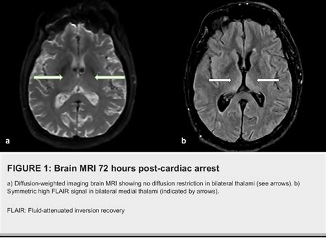 Figure 1 From Global Aphasia Secondary To Bilateral Thalamic