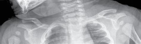 Clavicle Fracture Newborn Xray