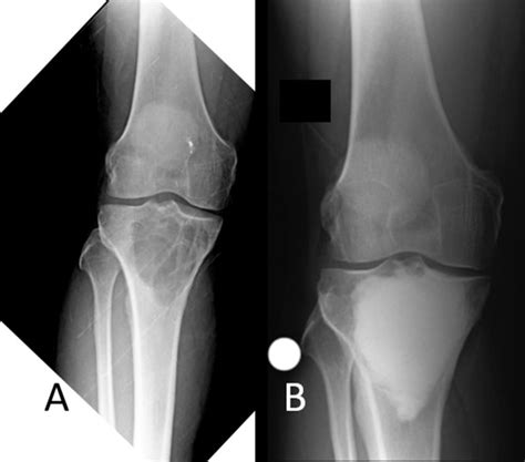 Is Higher Body Mass Index Associated With Secondary Osteoarthritis In