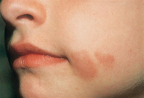 Afbeelding Van Phytophotodermatitis Huidproblemen En Behandelingen 2025