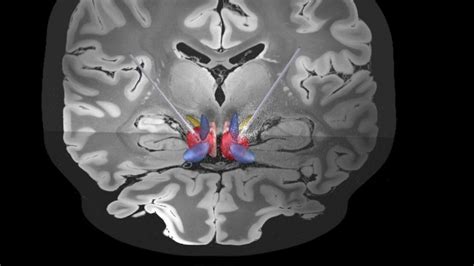 Electrodes In The Brain Abc News