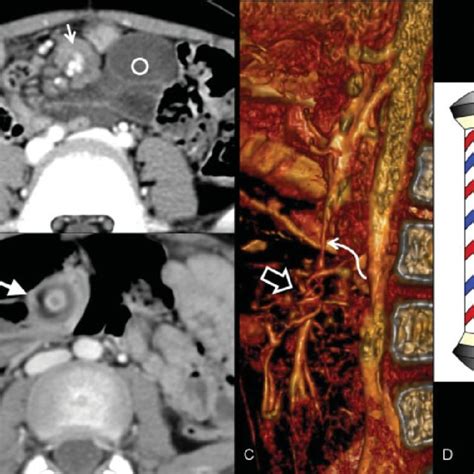 A Operative Photograph Showing Mesenteric Volvulus No Evidence Of