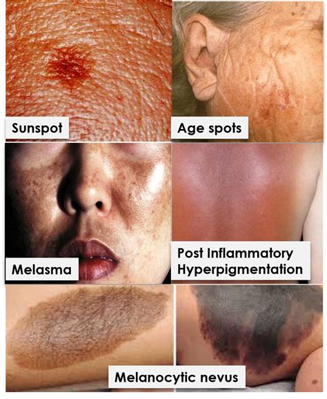 Hyperpigmentation Understanding Dark Patches On Skin