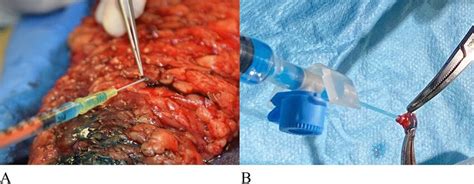 Fixative Flush Infused Into The Lymphatic Vessel A And Into The Vein
