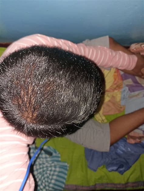 Is This Diffuse Thinning Or Mpb Pictures Of Both Wet And Dry Taken