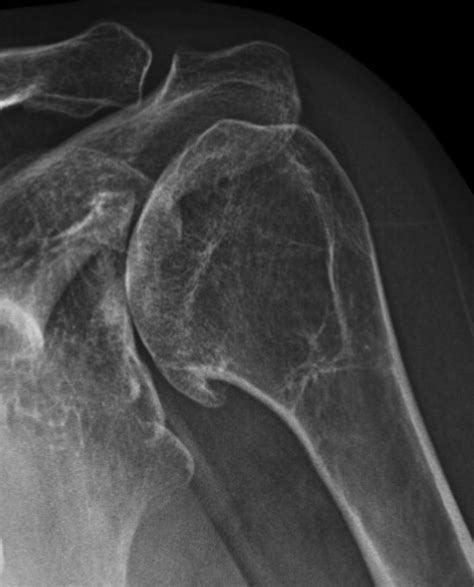 Uw Shoulder And Elbow Academy Glenoid Dysplasia
