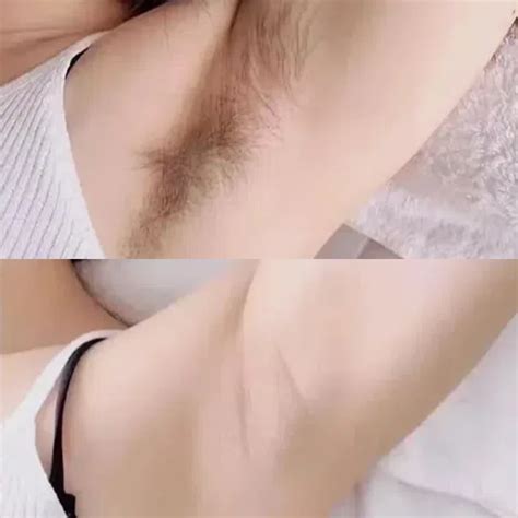 Professional Diode Laser Hair Removal Machine For Sale