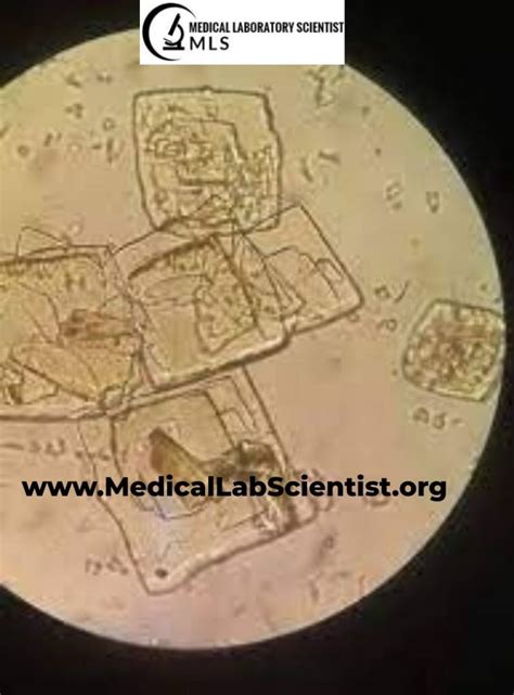 Cholesterol In Urine