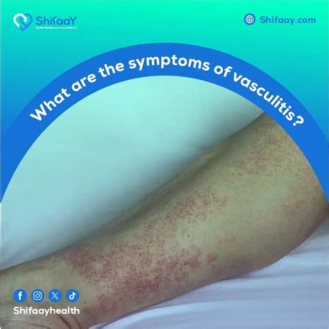What Are The Symptoms Of Vasculitis Shifaay