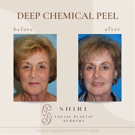 Deep Chemical Peels Before And After Shire Facial Plastic Surgery