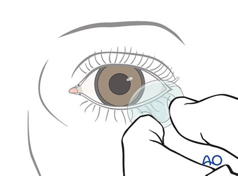 Transconjunctival Approach With Lateral Skin Extension