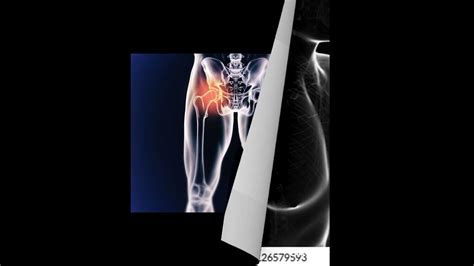 Arthrography Diagram 1 Youtube