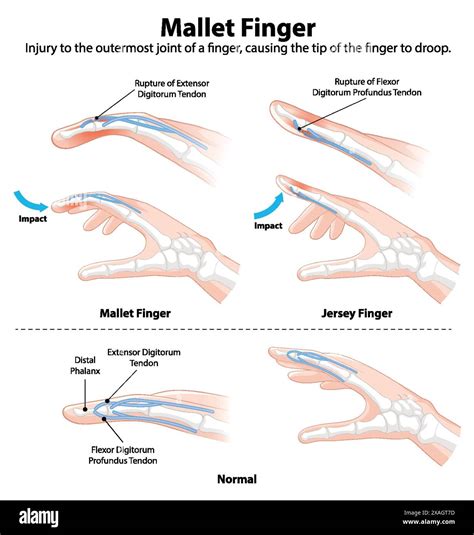 Illustration Of Finger Tendon Injuries And Normal Anatomy Stock Vector