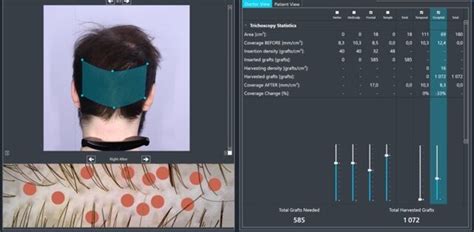 Trichoscopy Hair Transplant Planning And Simulation