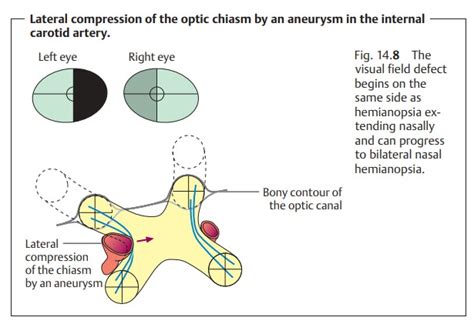 Chiasmal Lesions