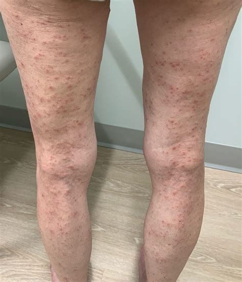 Uv Phototherapy For Atopic Dermatitis Eczema Grand Strand