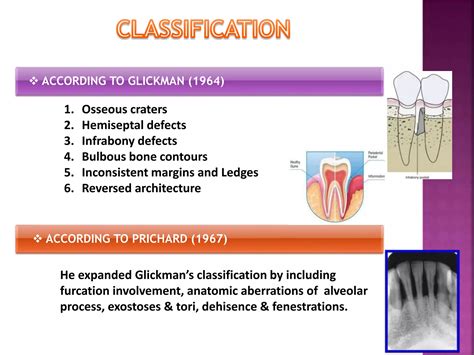 Patterns Of Bone Destruction In Periodontics Pptx
