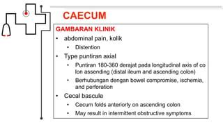 Volvulus Pptx