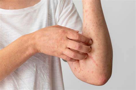 Aquagenic Urticaria Causes Symptoms And Management
